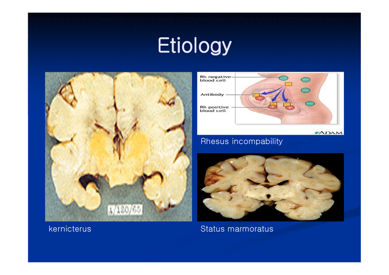 Athetosis Definition Athetosis Etiology - 의약학
