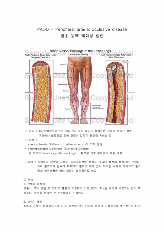 병태생리 PAOD - Peripheral arterial occlusive disease(말초 동맥 폐쇄성 질환) - 의약학