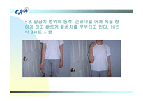 Medial Apophysitis (Little Leaguer s Elbow) - 의약학