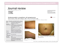 Pruritic urticarial papules and plaques of pregnancy (PUPPP) 피부과 대본있음 - 의약학